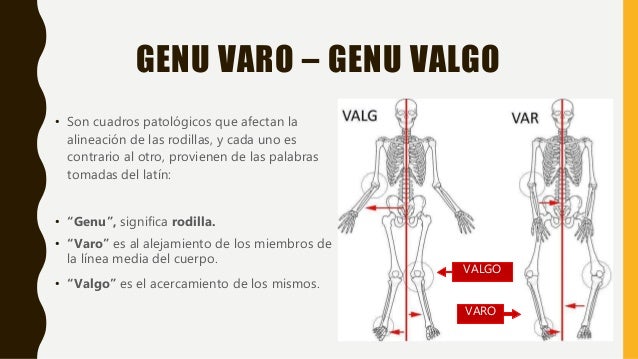 Genu valgo