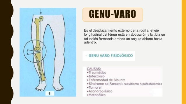 Genu valgo