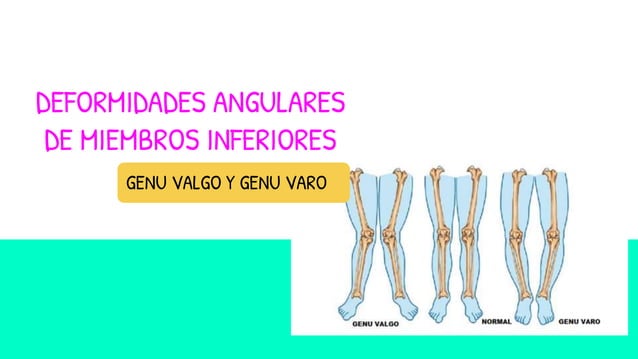 Genu valgo y genu varo.pptxFSFETERTETETETET | PPTX