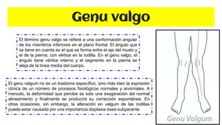 Genu valgo y genu varo.pptxFSFETERTETETETET | PPTX