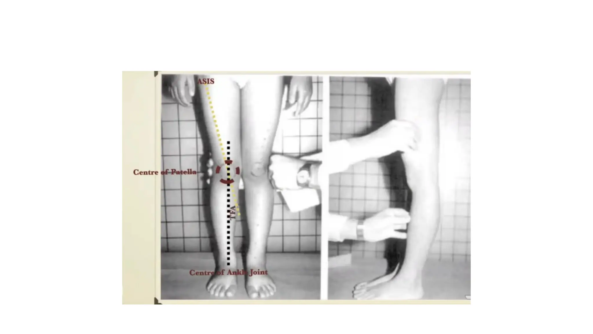 GENU VALGUM knee deformity clinical case | PPTX