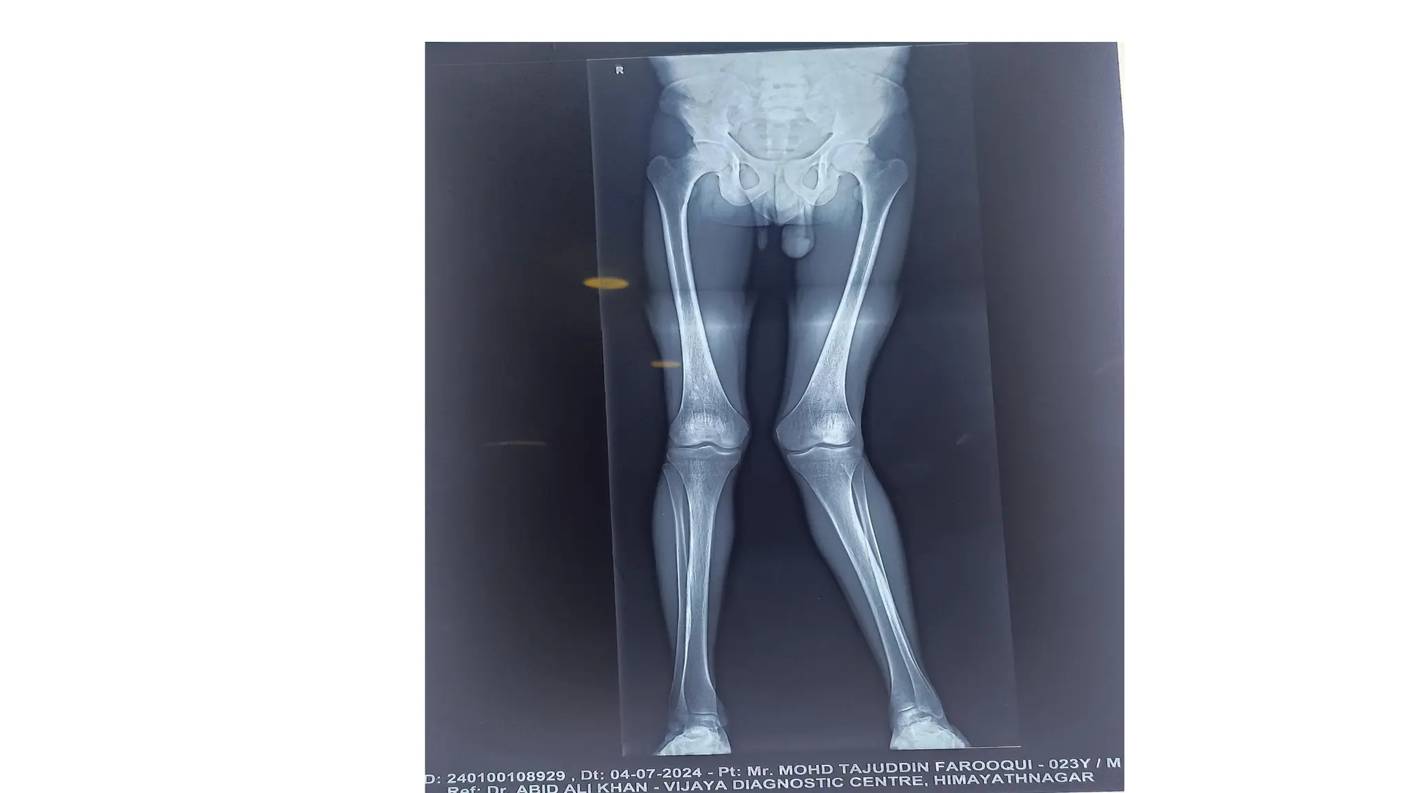 GENU VALGUM knee deformity clinical case | PPTX