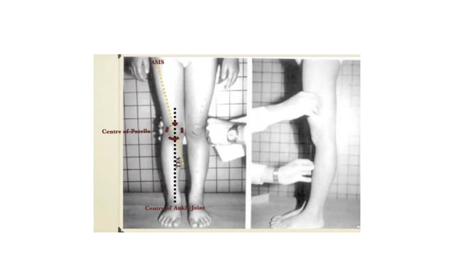 GENU VALGUM knee deformity clinical case | PPT