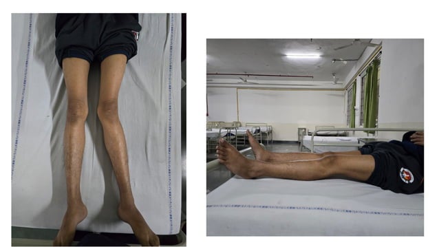 GENU VALGUM knee deformity clinical case | PPT
