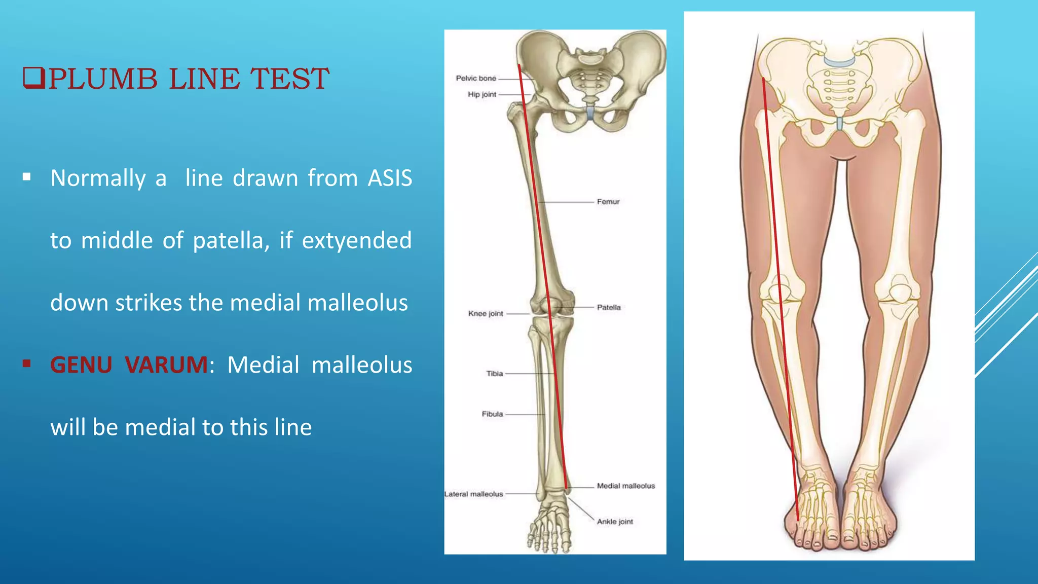 GENU VALGUM & VARUM.pptx