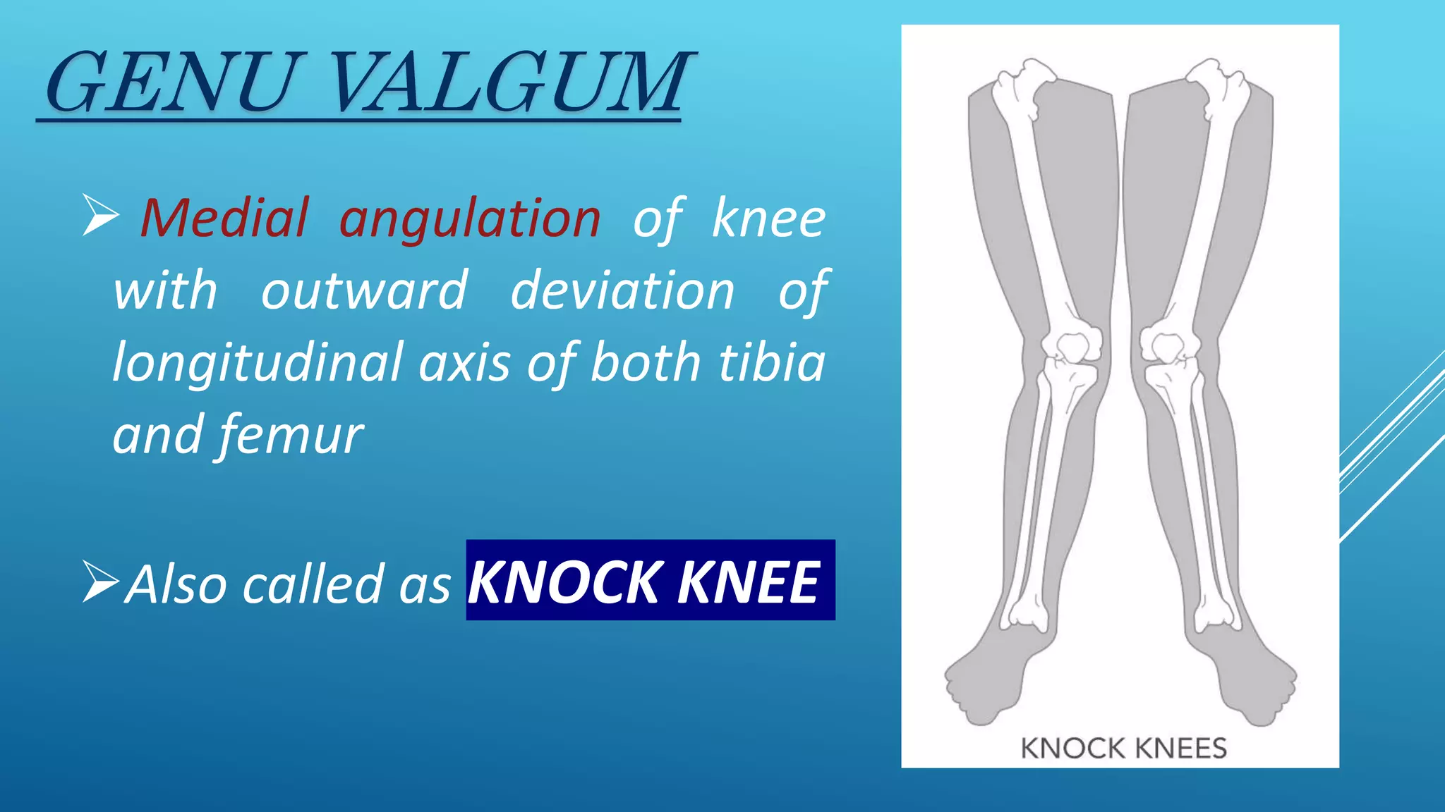 GENU VALGUM & VARUM.pptx