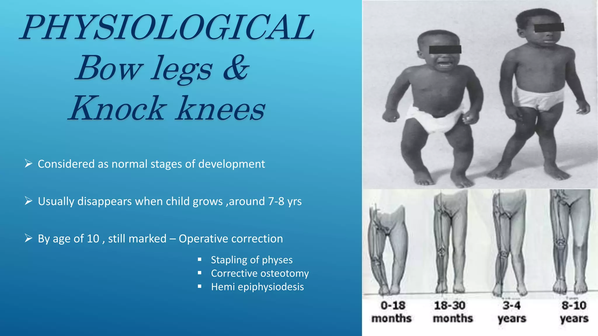 GENU VALGUM & VARUM.pptx