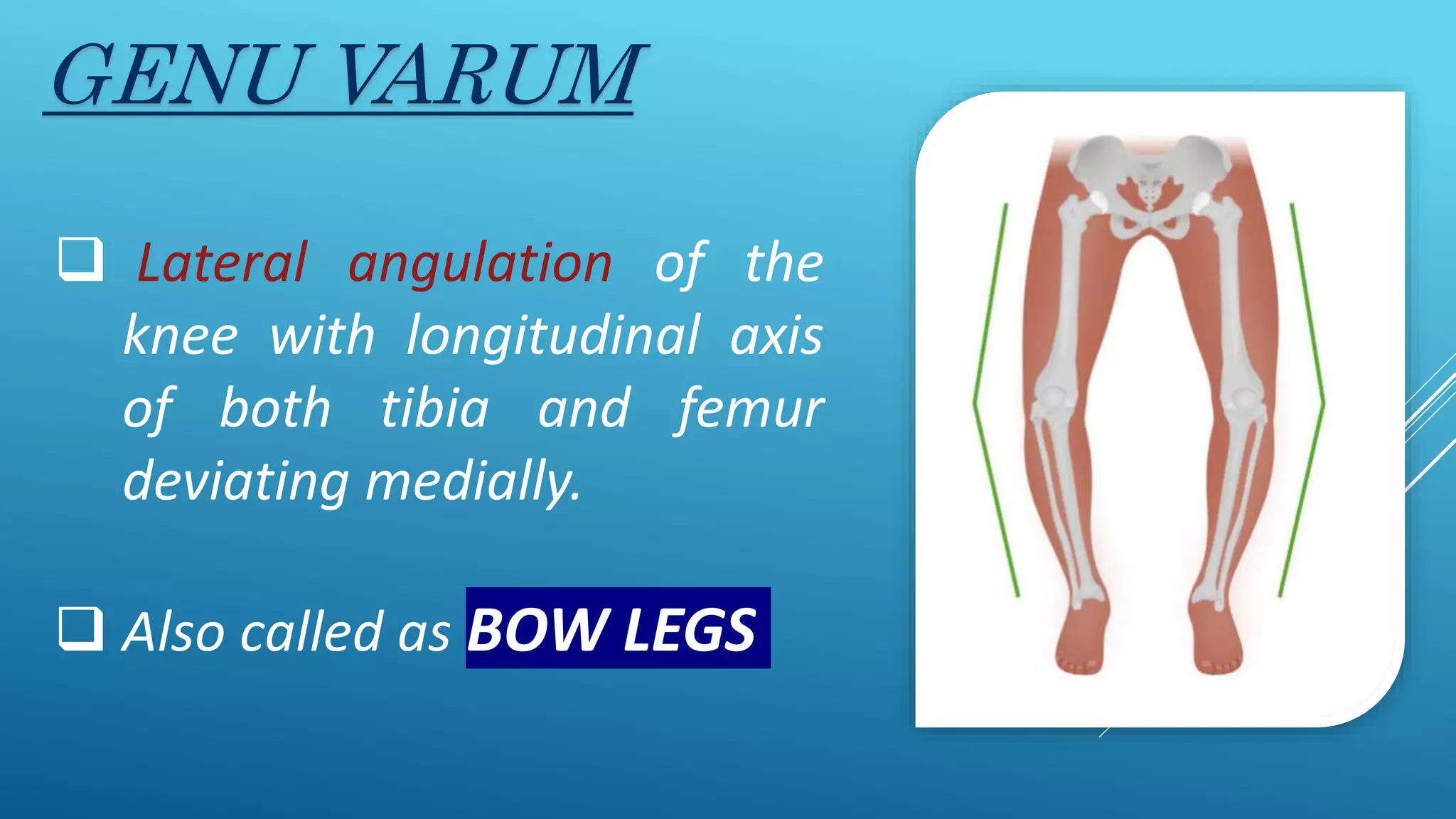 GENU VALGUM & VARUM.pptx