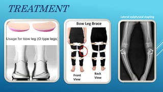 GENU VALGUM & VARUM.pptx