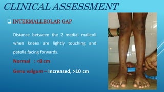 GENU VALGUM & VARUM.pptx