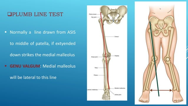 GENU VALGUM & VARUM.pptx