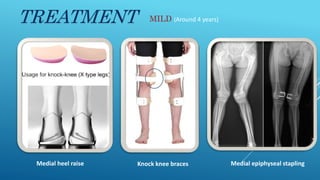 GENU VALGUM & VARUM.pptx