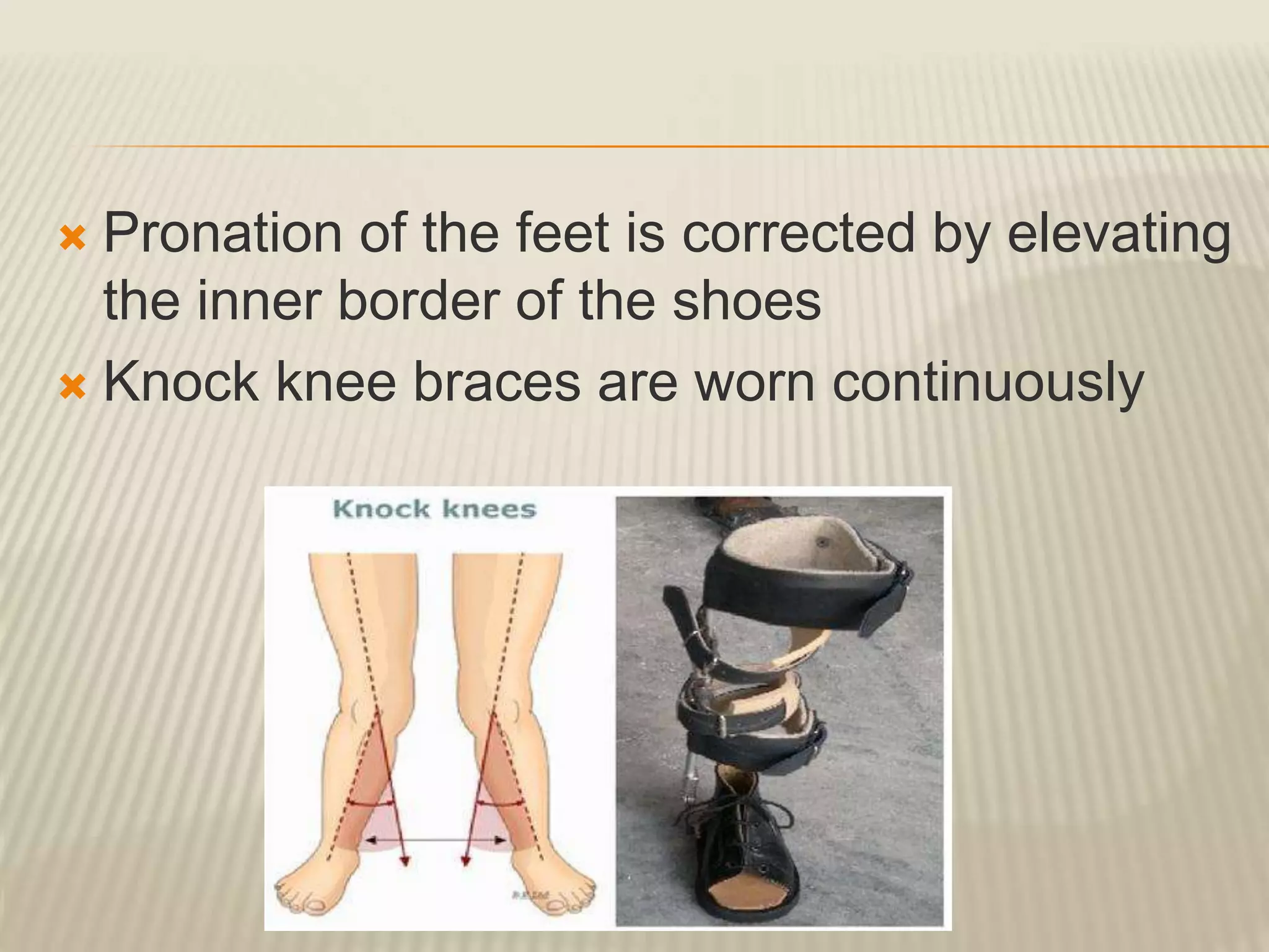 Genu valgus | PPTX