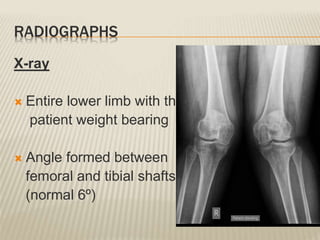 Genu valgus | PPTX