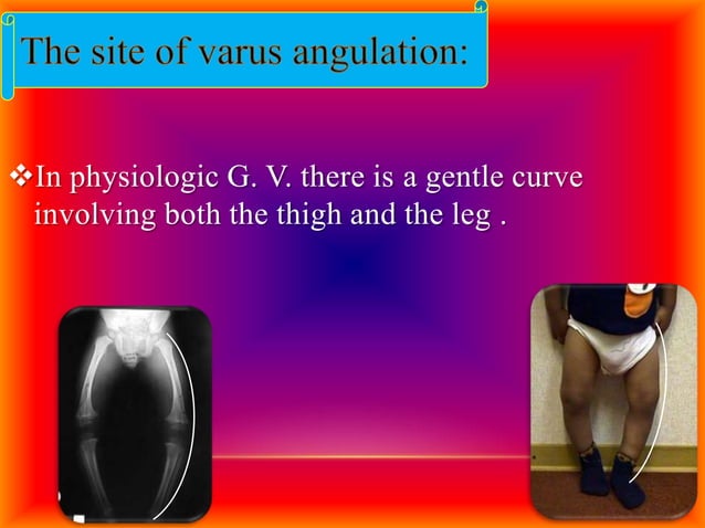 Genu varum | PPTX
