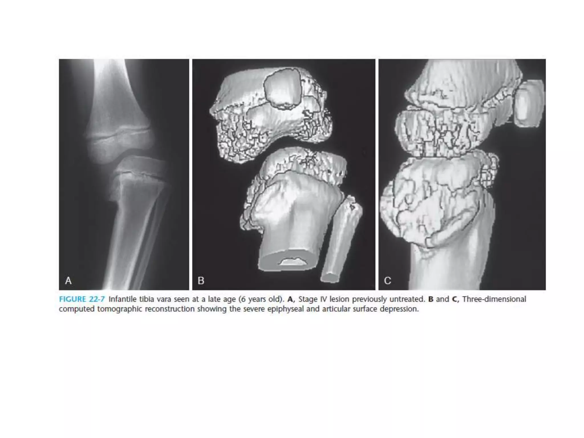 Genu varum, Genu valgum, Genu recurvatum | PPTX