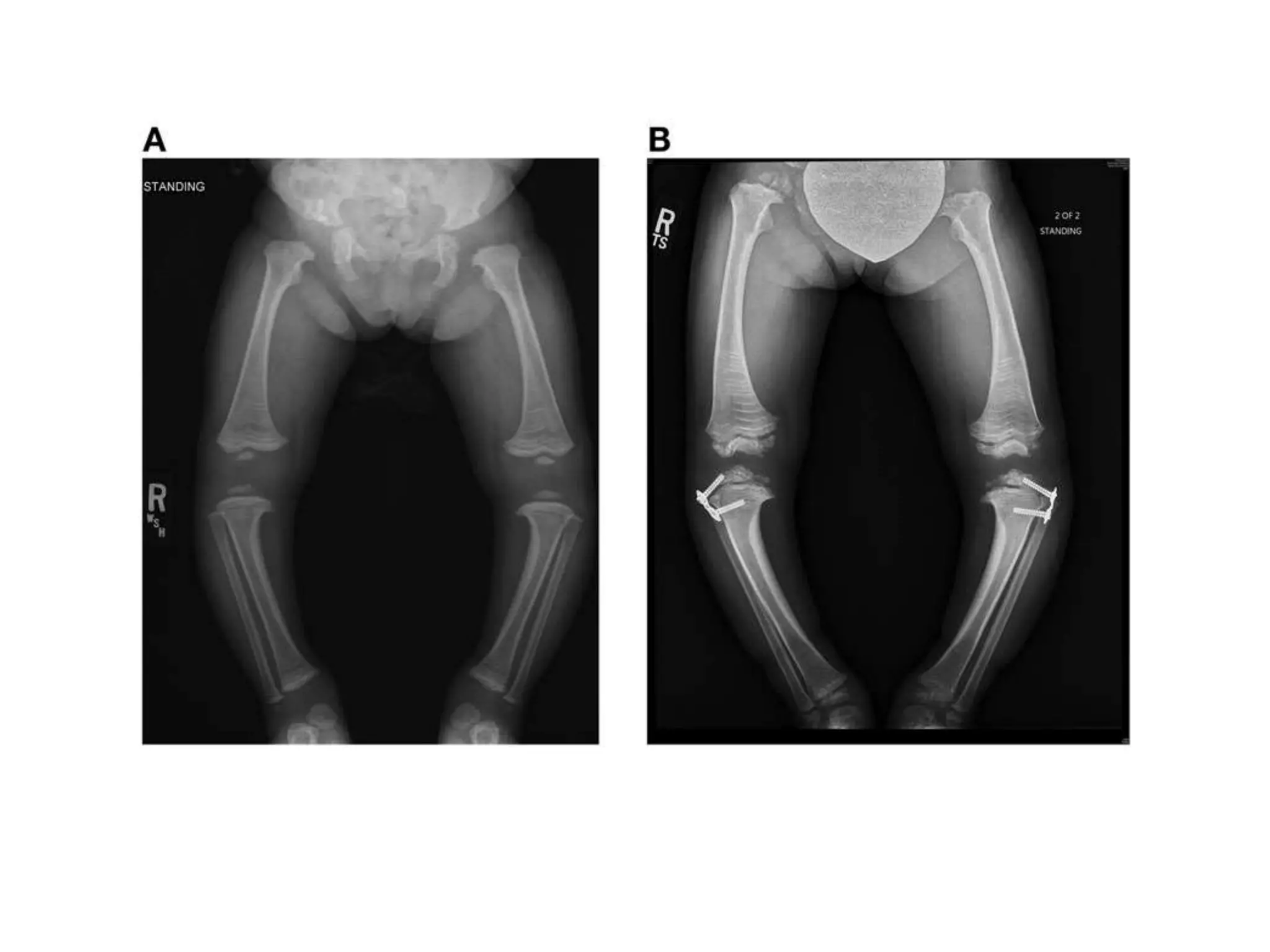 Genu varum, Genu valgum, Genu recurvatum | PPTX
