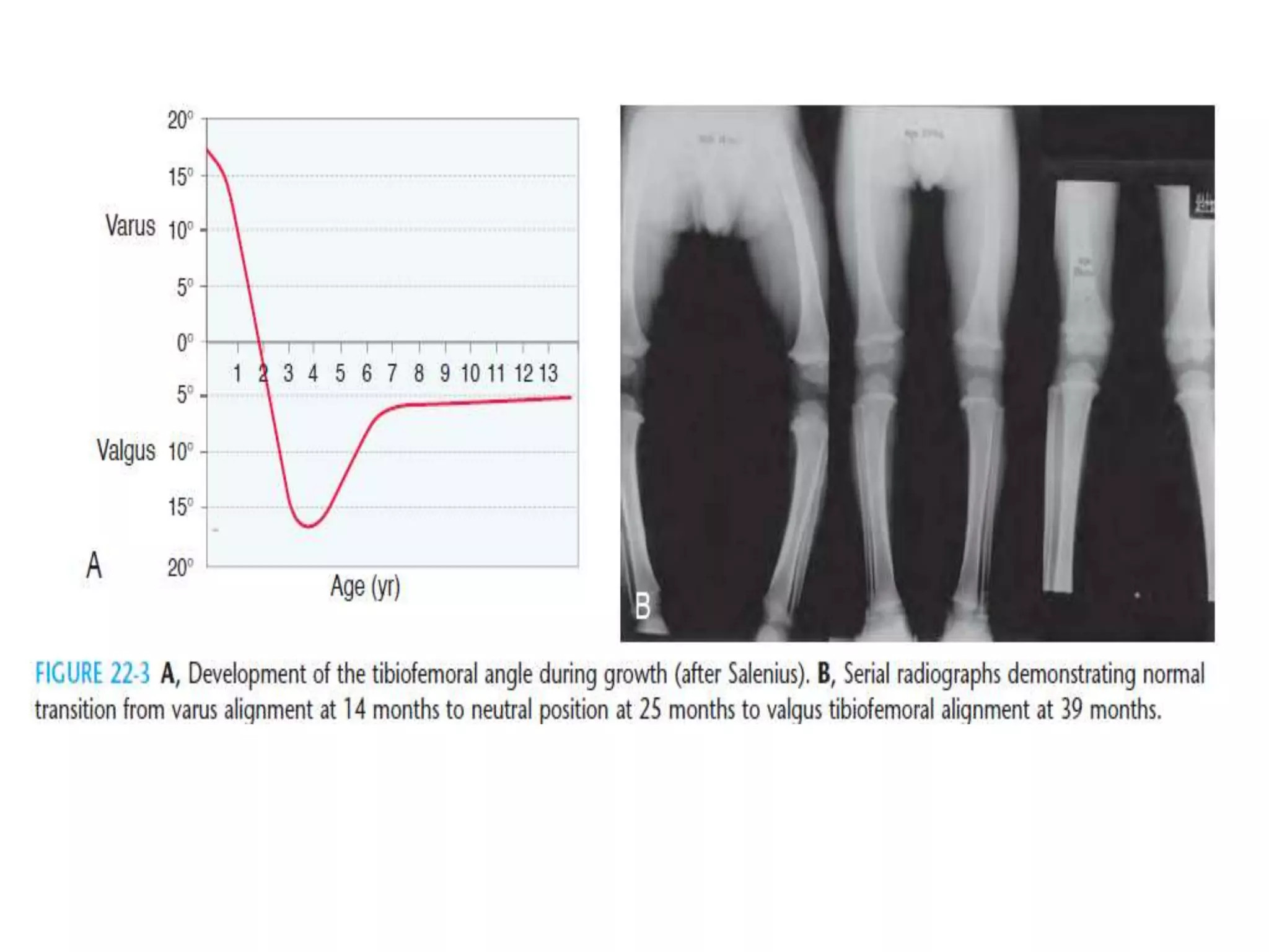 Genu varum, Genu valgum, Genu recurvatum | PPTX