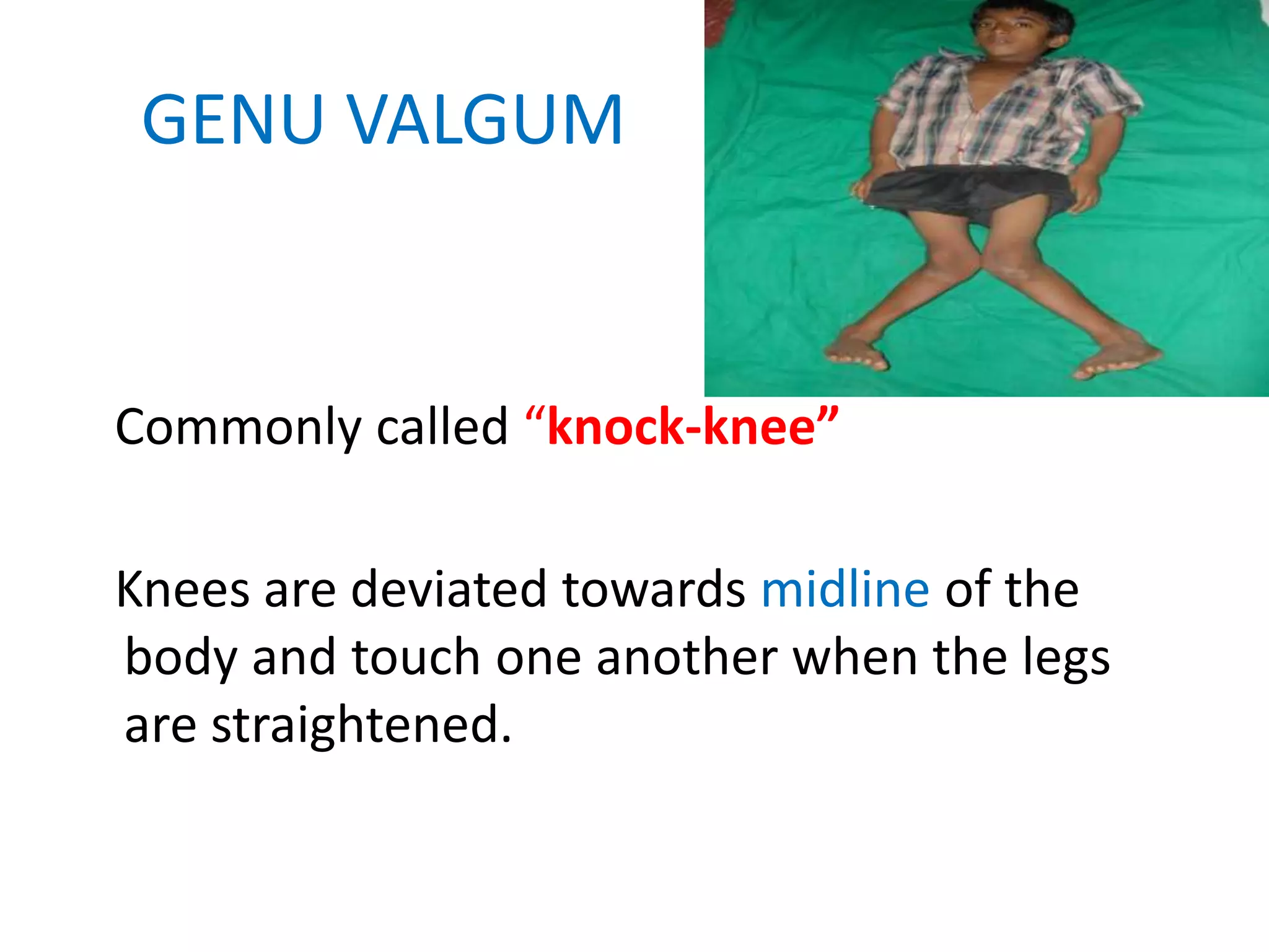 Genu varum, Genu valgum, Genu recurvatum | PPTX