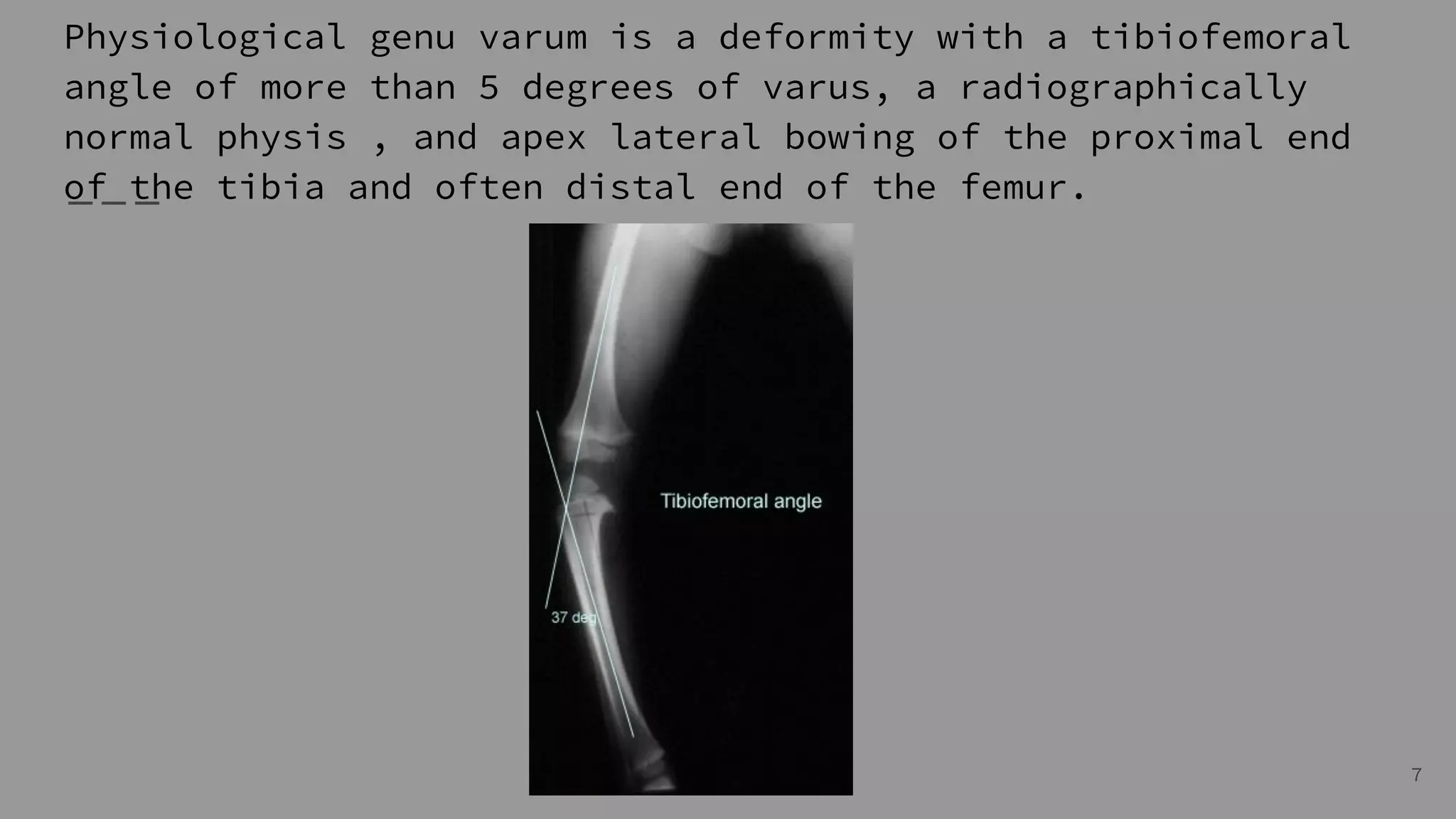 Genu varum orthotic management | PDF