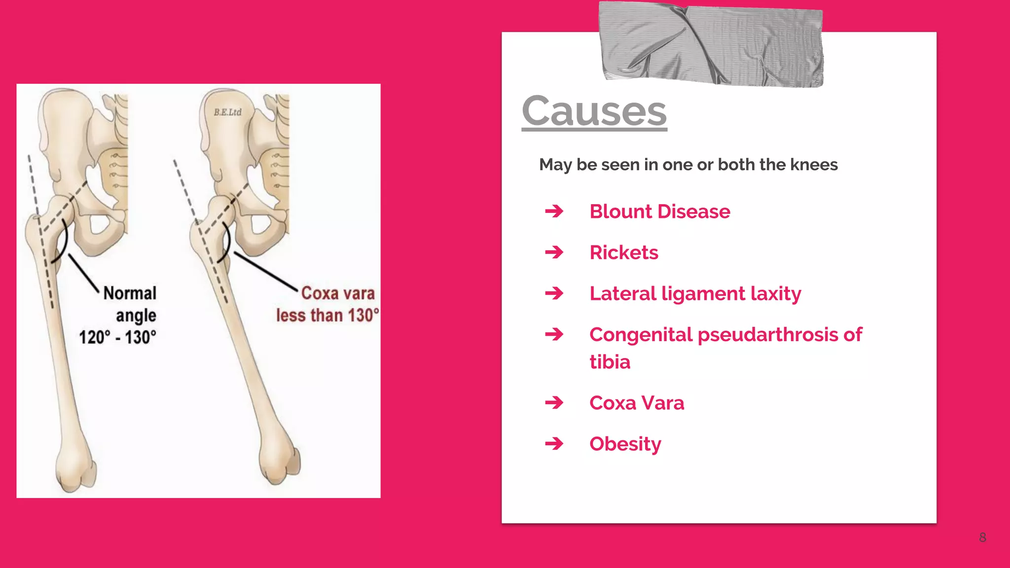 Genu varum orthotic management | PDF