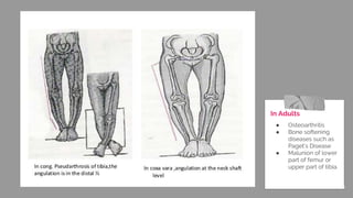 Genu varum orthotic management | PDF
