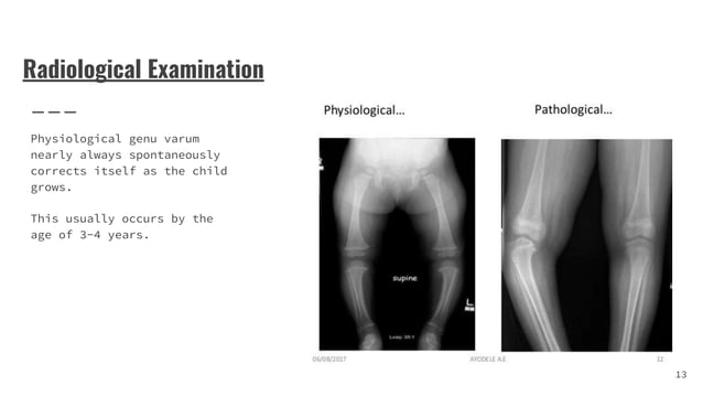 Genu varum orthotic management | PDF