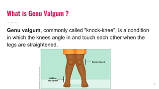 Genu varum orthotic management | PDF