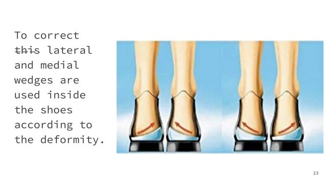 Genu varum orthotic management | PDF