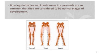 Genu varum orthotic management | PDF