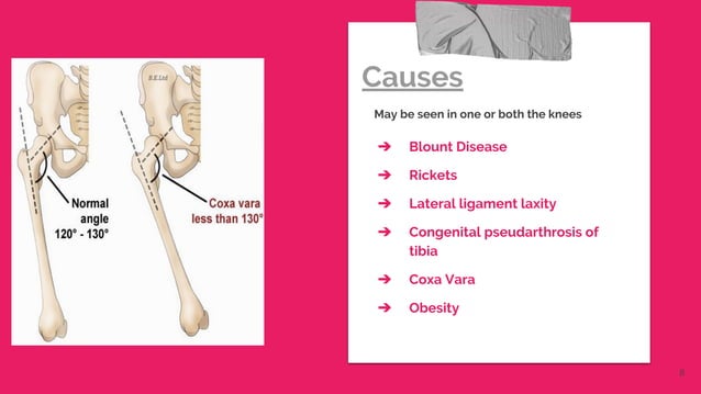Genu varum orthotic management | PDF