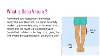 Genu varum orthotic management | PPT