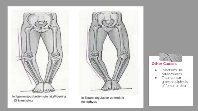 Genu varum orthotic management