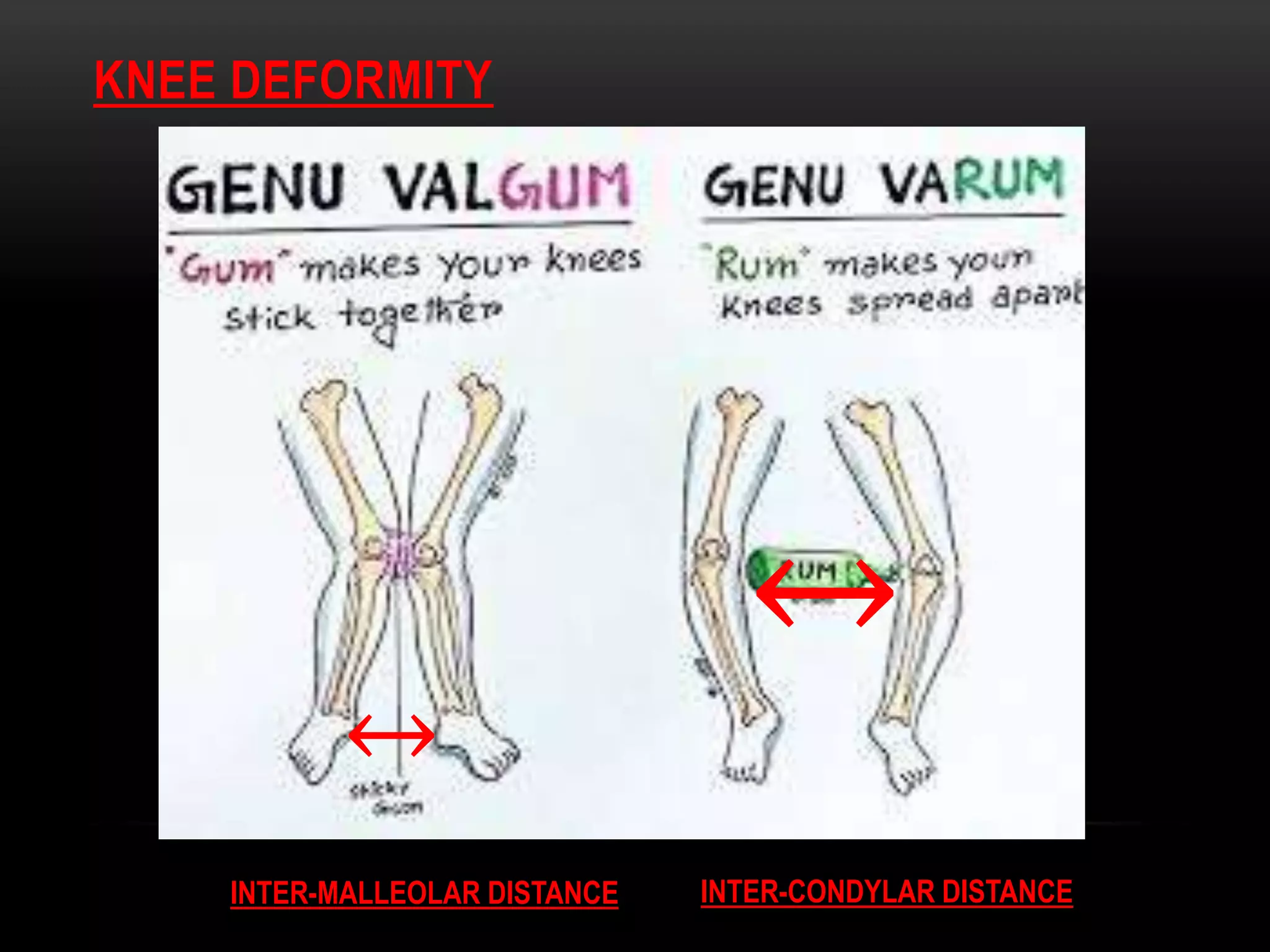 Genu varum valgus ,coxa varum | PPTX