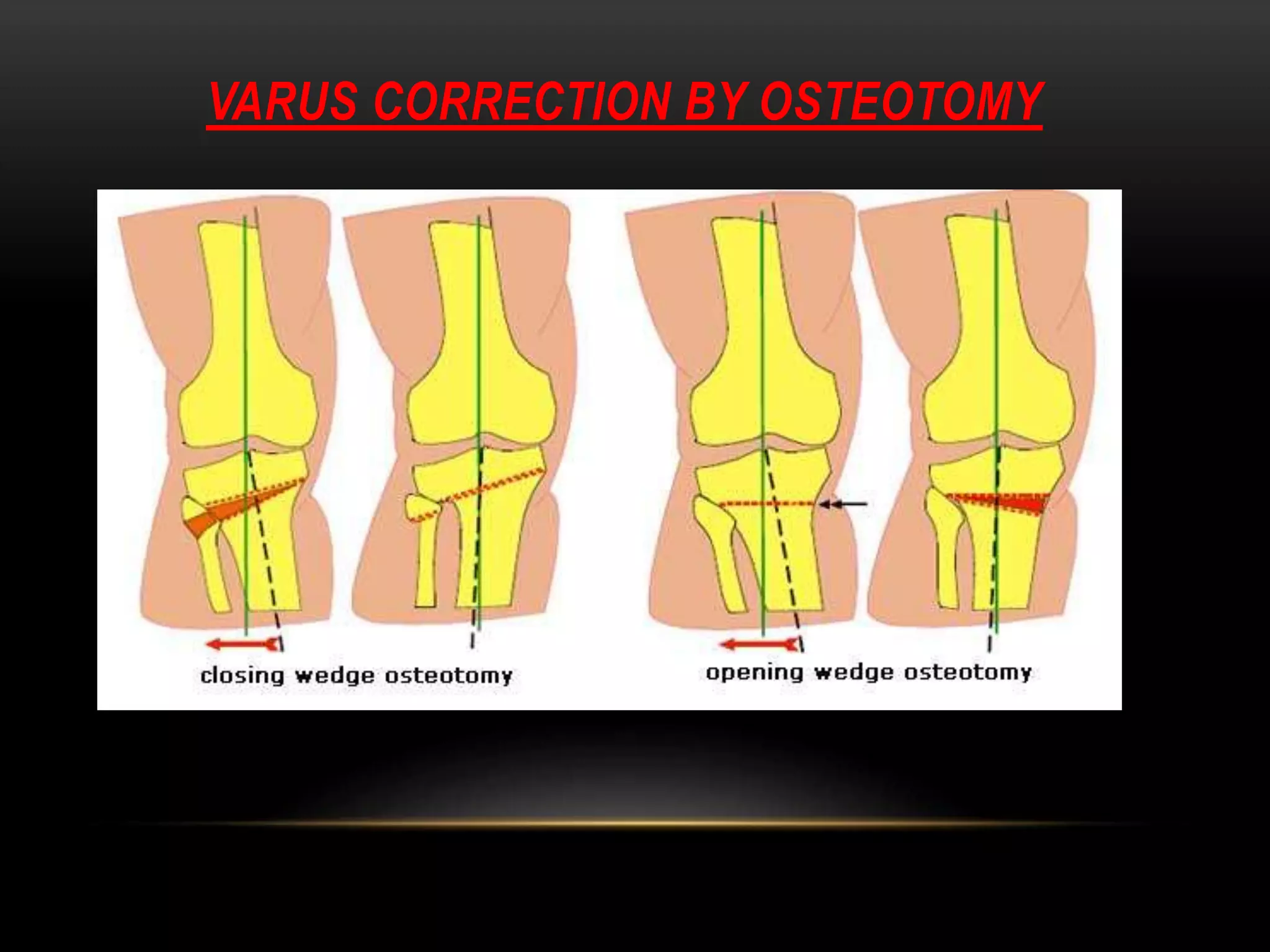 Genu varum valgus ,coxa varum | PPTX