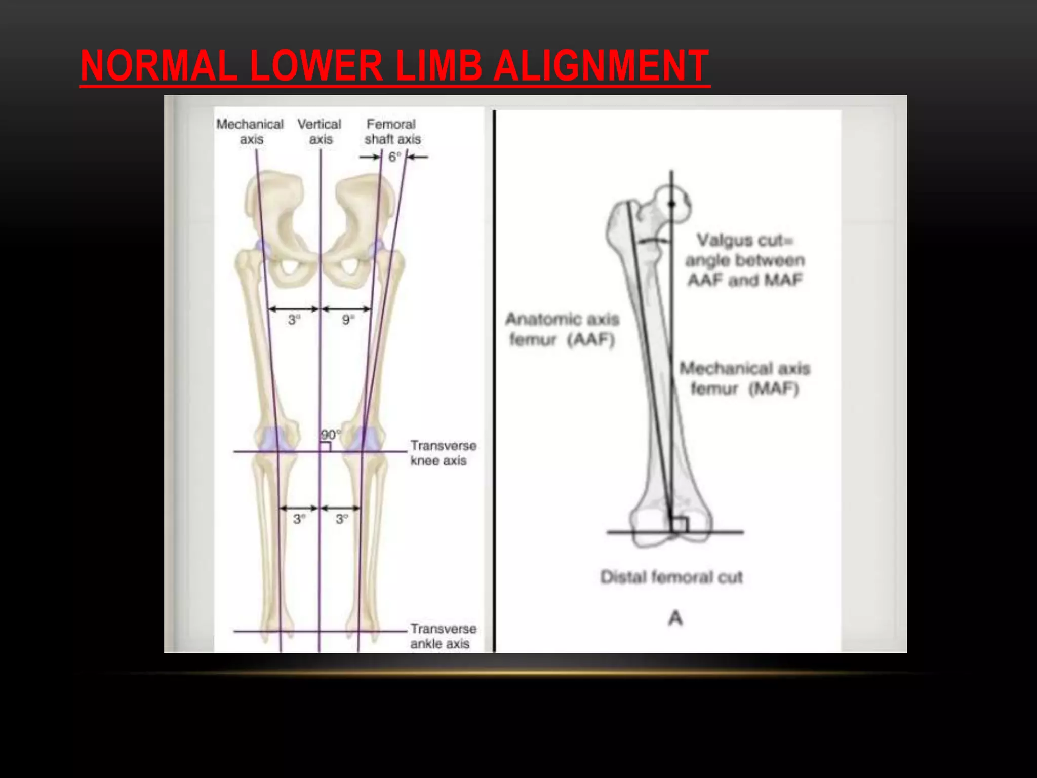 Genu varum valgus ,coxa varum | PPTX