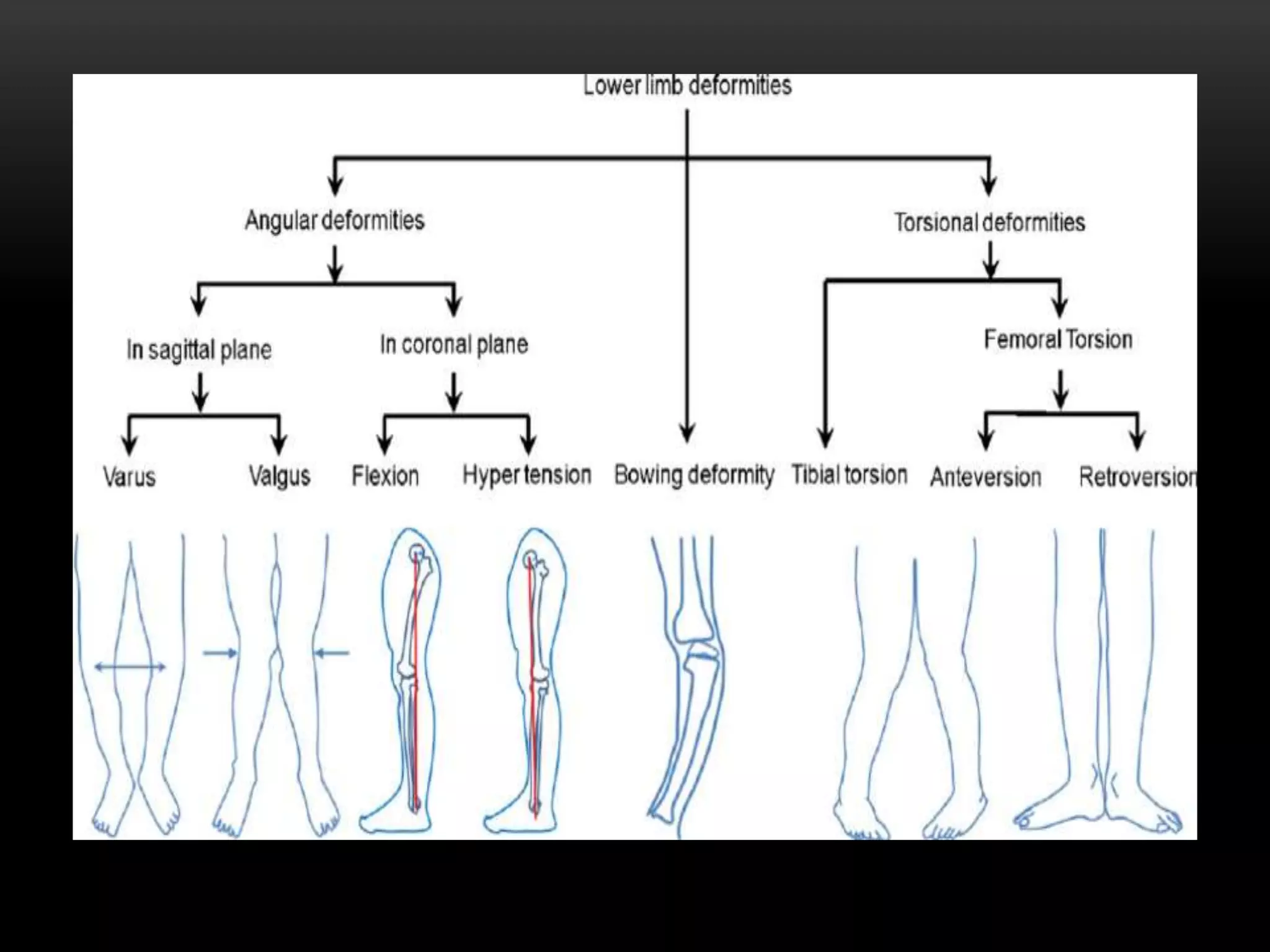 Genu varum valgus ,coxa varum | PPTX