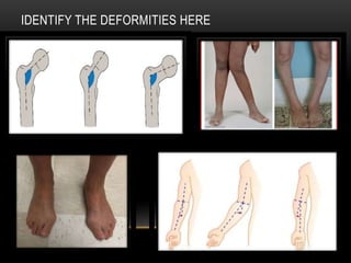 Genu varum valgus ,coxa varum | PPTX