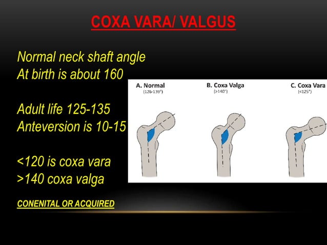 Genu varum valgus ,coxa varum | PPTX