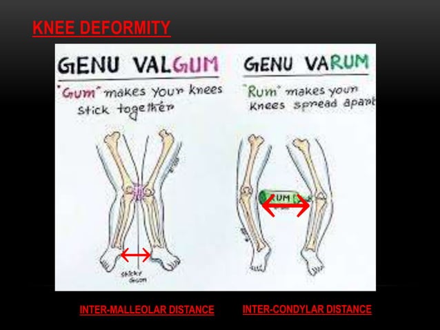 Genu Varum Valgus Coxa Varum Ppt