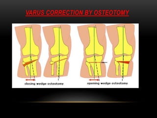 Genu varum valgus ,coxa varum | PPTX