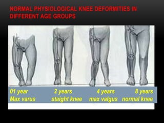 Genu varum valgus ,coxa varum | PPT