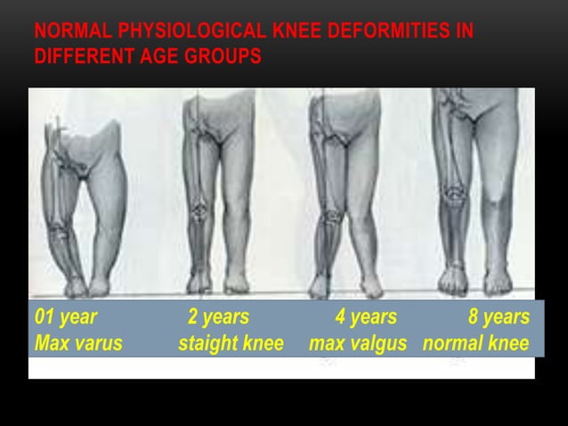 Genu varum valgus ,coxa varum