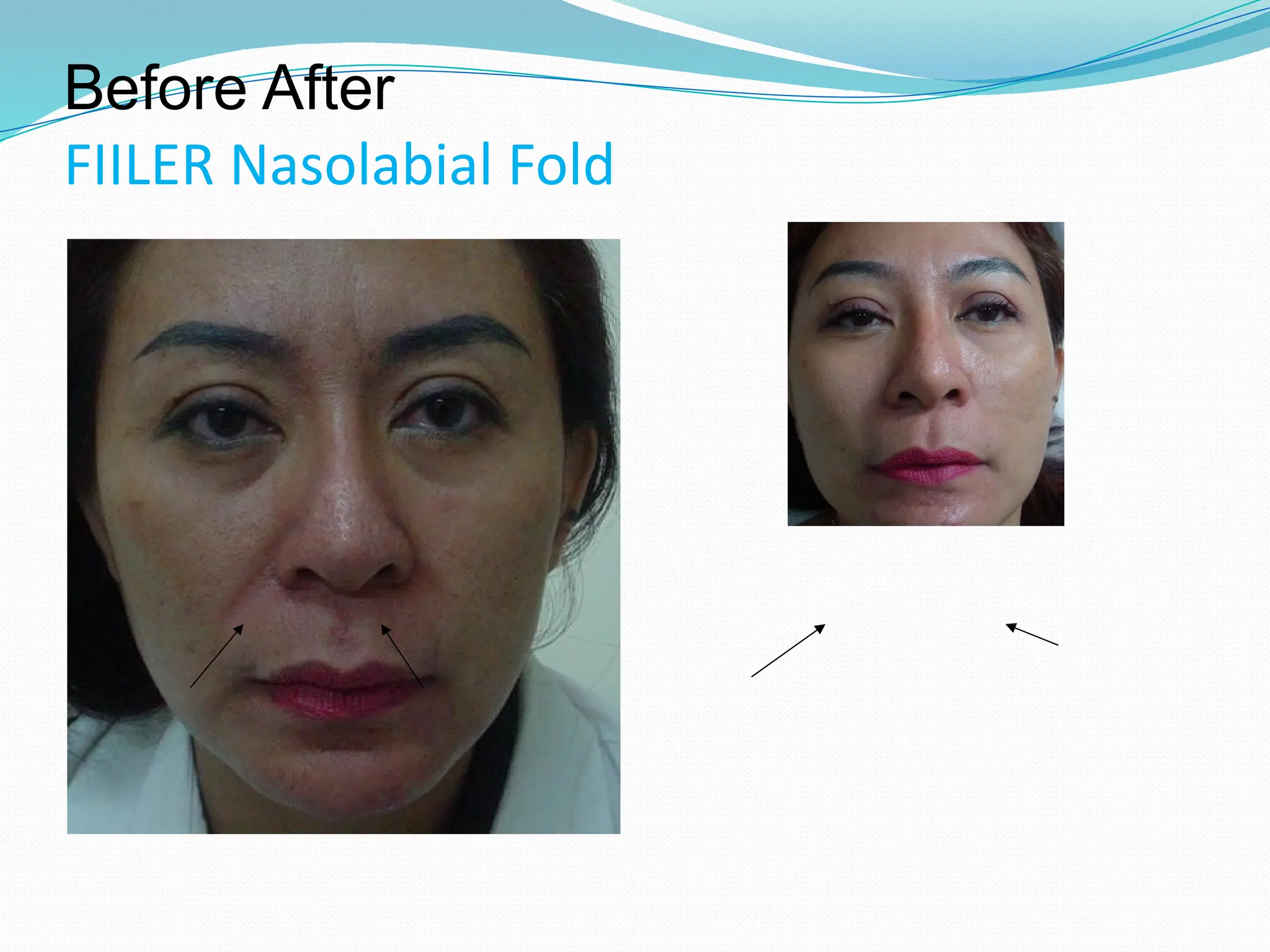 Filler Jenis Indikasi Komplikasi dan Penangannanya | PPTX