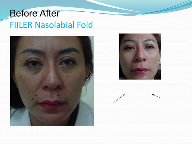 Filler Jenis Indikasi Komplikasi dan Penangannanya | PPTX