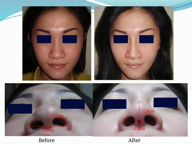 Filler Jenis Indikasi Komplikasi dan Penangannanya | PPTX