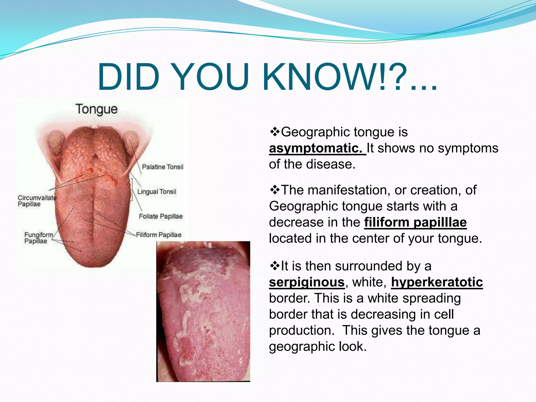 Geographic tongue disease powerpoint | PPTX
