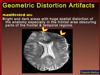 Geometric distortion artifact remedy | PPT