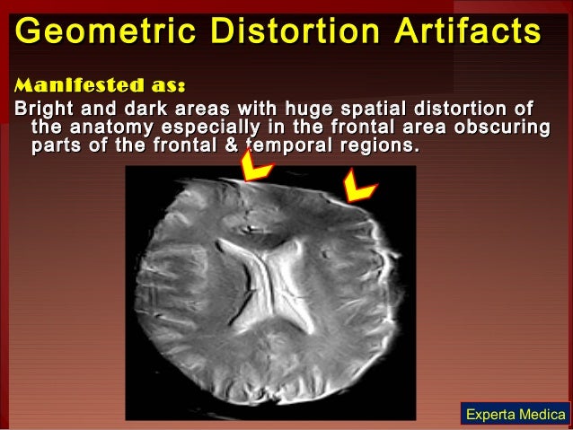 Geometric distortion artifact remedy