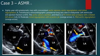 Evaluation of Mixed Valvular Heart Disease on Echo | PPTX